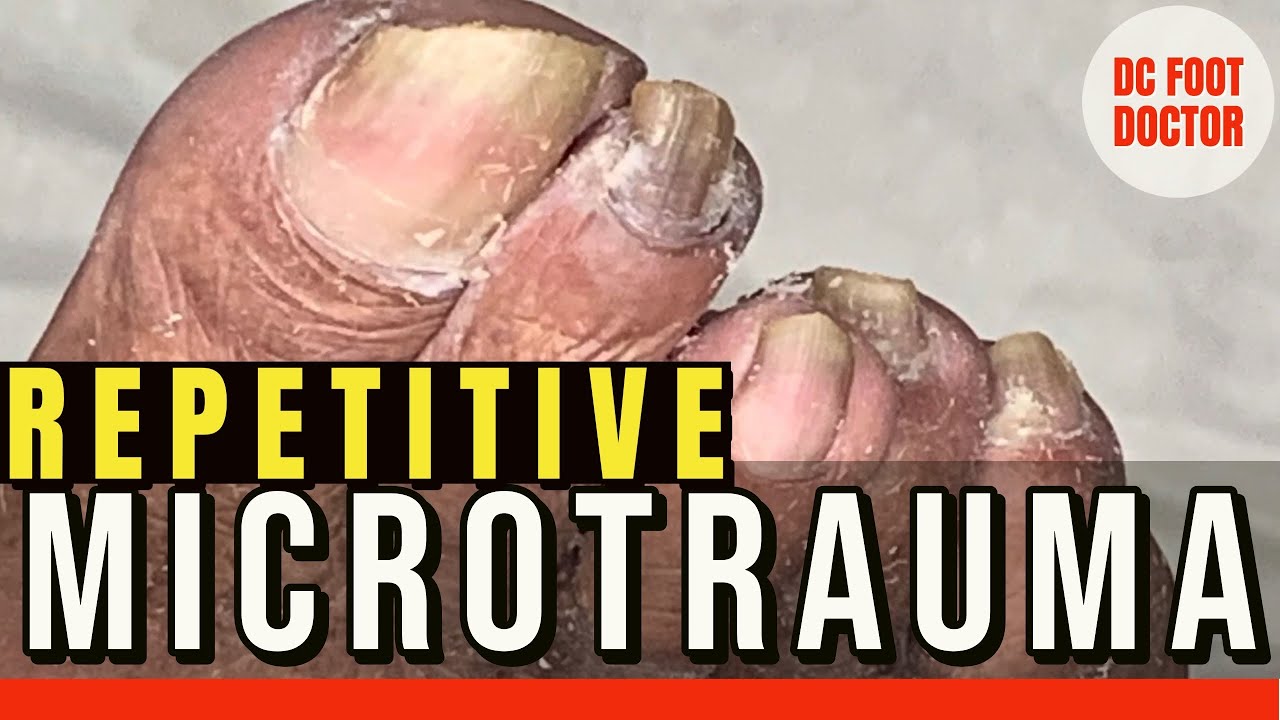 REPETITIVE MICROTRAUMA: Trimming Thick Toenails - YouTube