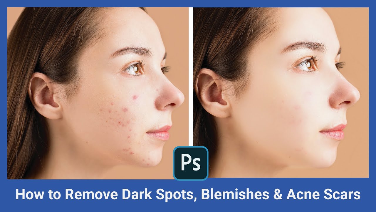 How to Remove Dark Spots, Blemishes & Acne Scars | Face Retouching ...