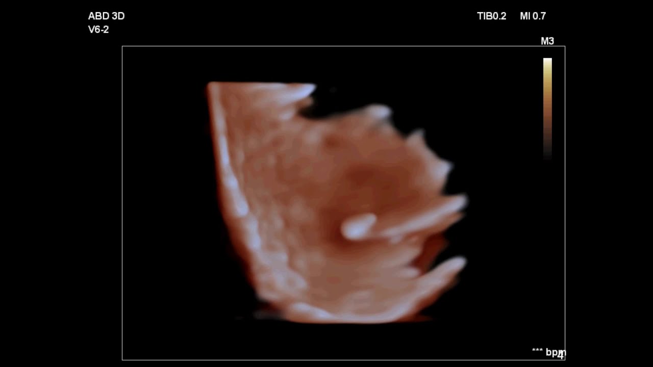 Ureteric Calculus at VUJ || Ultrasound || Case 07 - YouTube
