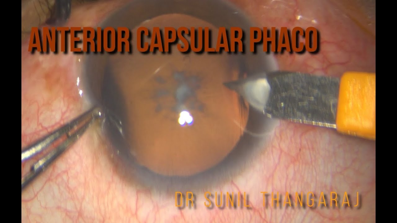 Anterior Capsular Cataract-Safe Fast and Easy Phaco - YouTube