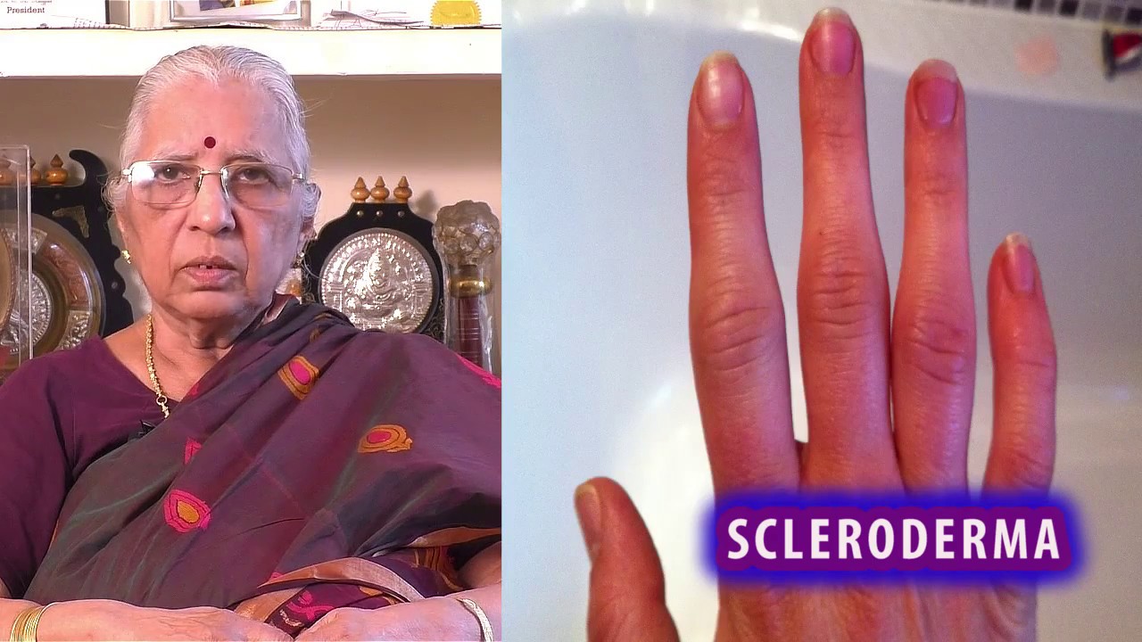 Scleroderma Treatment | Dr.P.S Lalitha | Drugless Therapy | Reiki Treatment - YouTube
