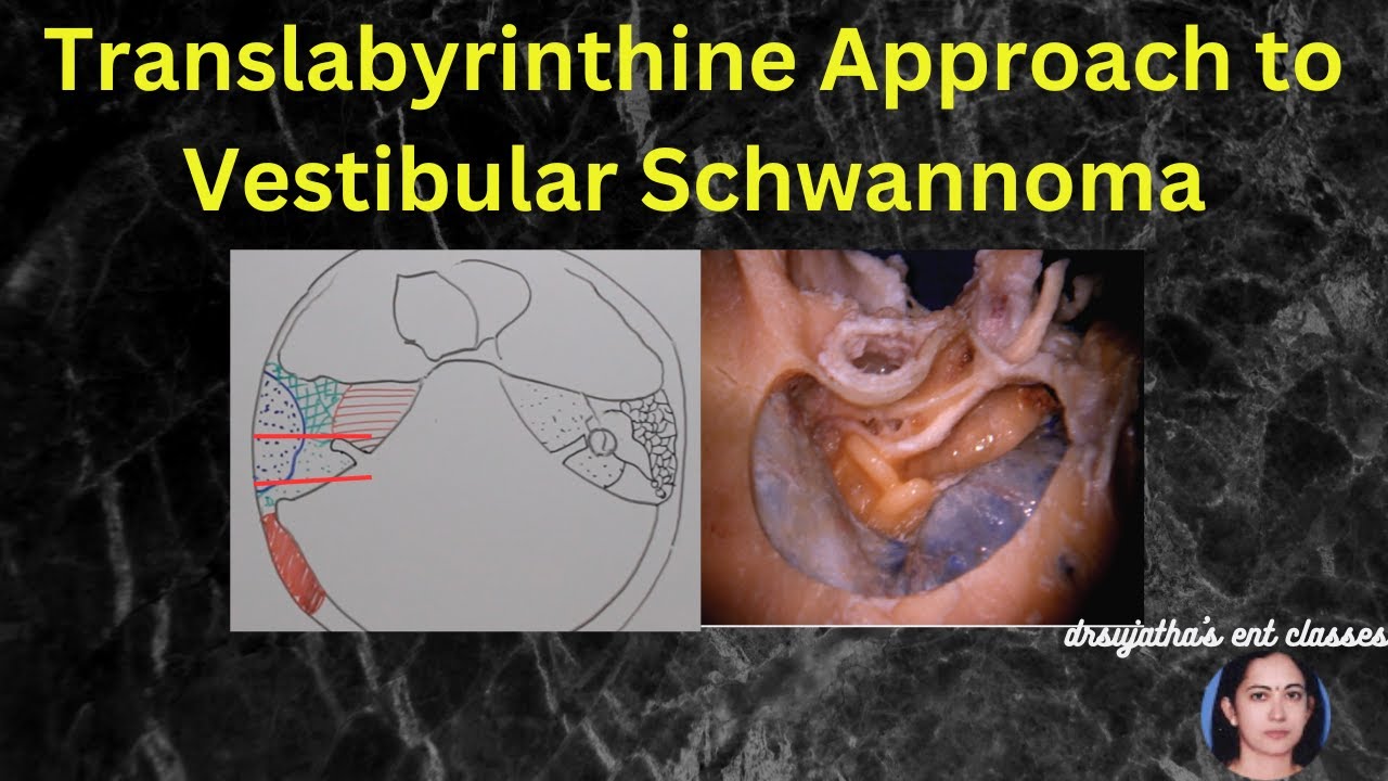 244. Translabrynthine Approach to Vestibular Schwannoma # ...
