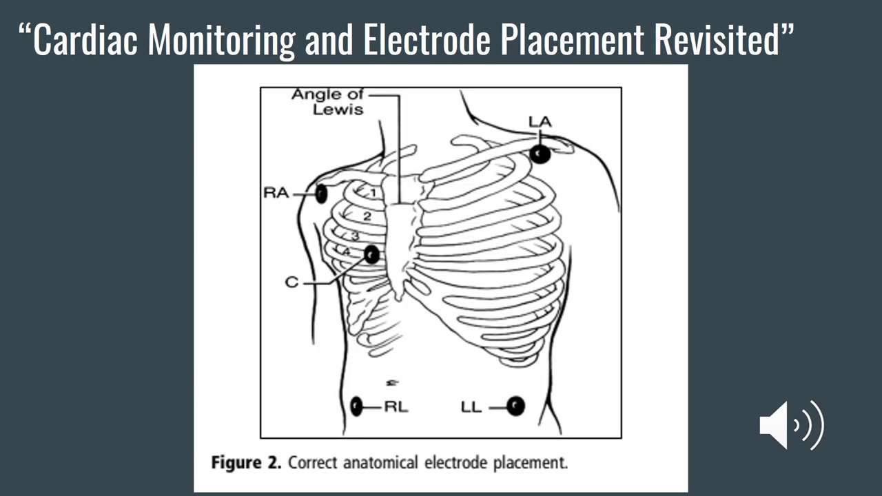 Telemetry Lead Placement - YouTube