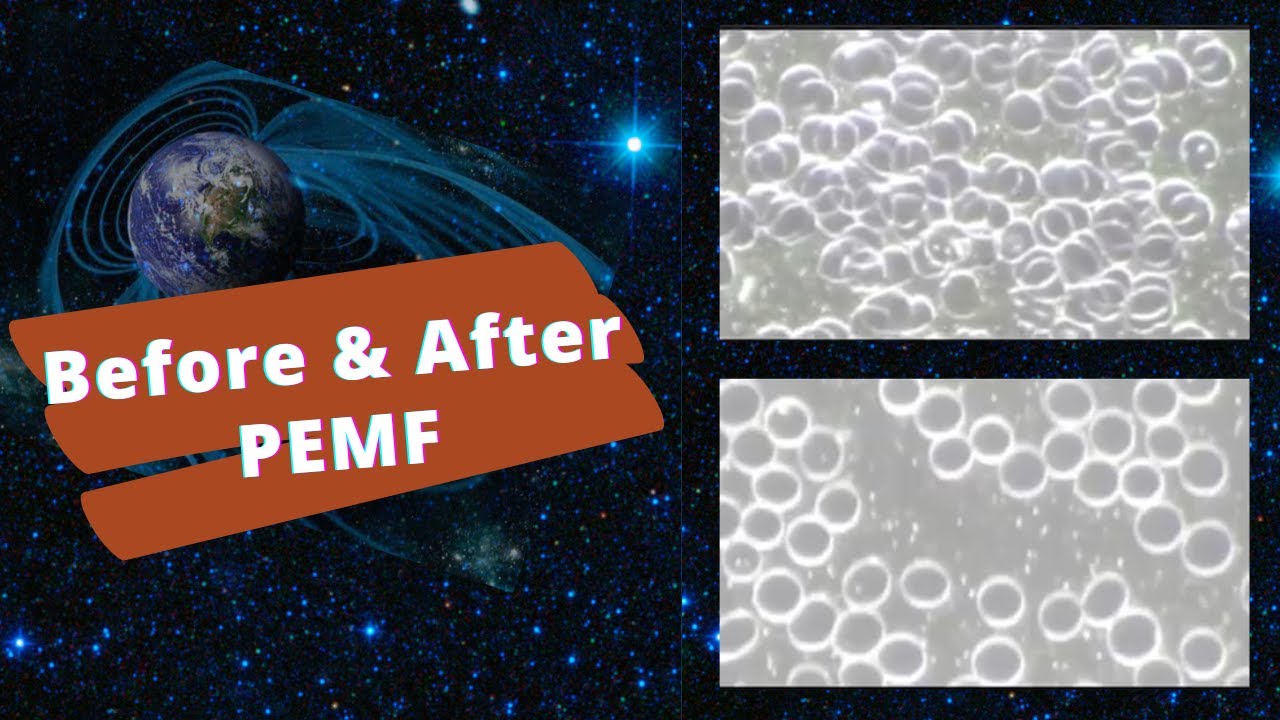 Images of Before And After A PEMF Therapy Session | Blood Microscopies ...