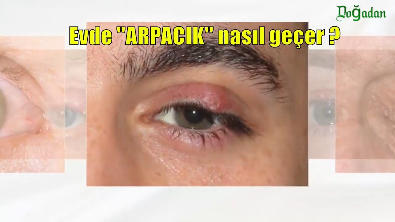 ARPACIK NASIL GEÇER ? | EVDE ARPACIK TEDAVİSİ - YouTube