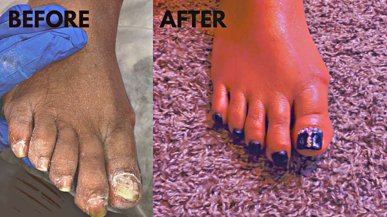 Black acrylic toes overlay - YouTube