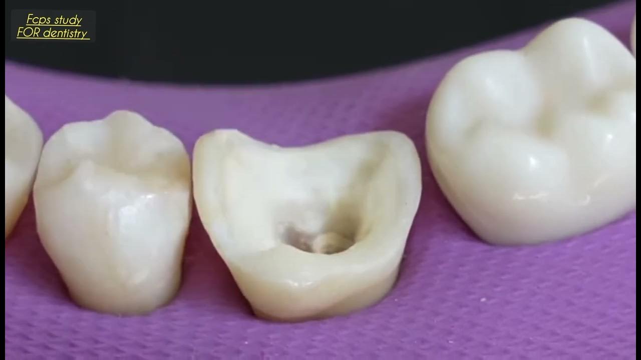 Restoring a grossly carious tooth/ROOT CANAL TREATMENT - YouTube