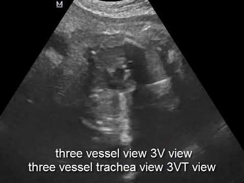 case 570 fetal echo normal three vessel trachea view 3VT - YouTube