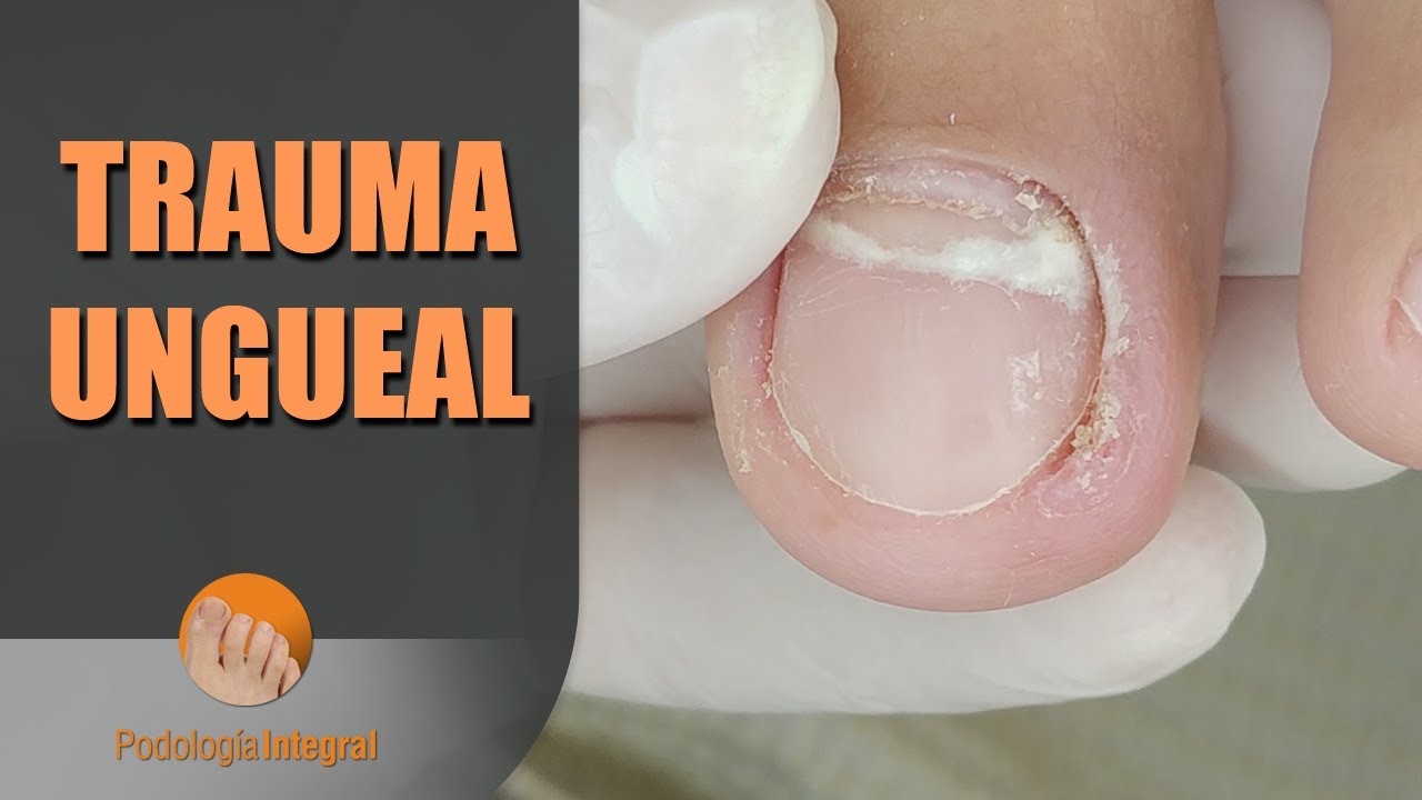 Nail trauma #podologiaintegral - YouTube