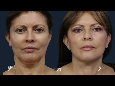 Facial Rejuvenation: Neck lift + CO2 Laser | Before and After  | Dr. David Stoker