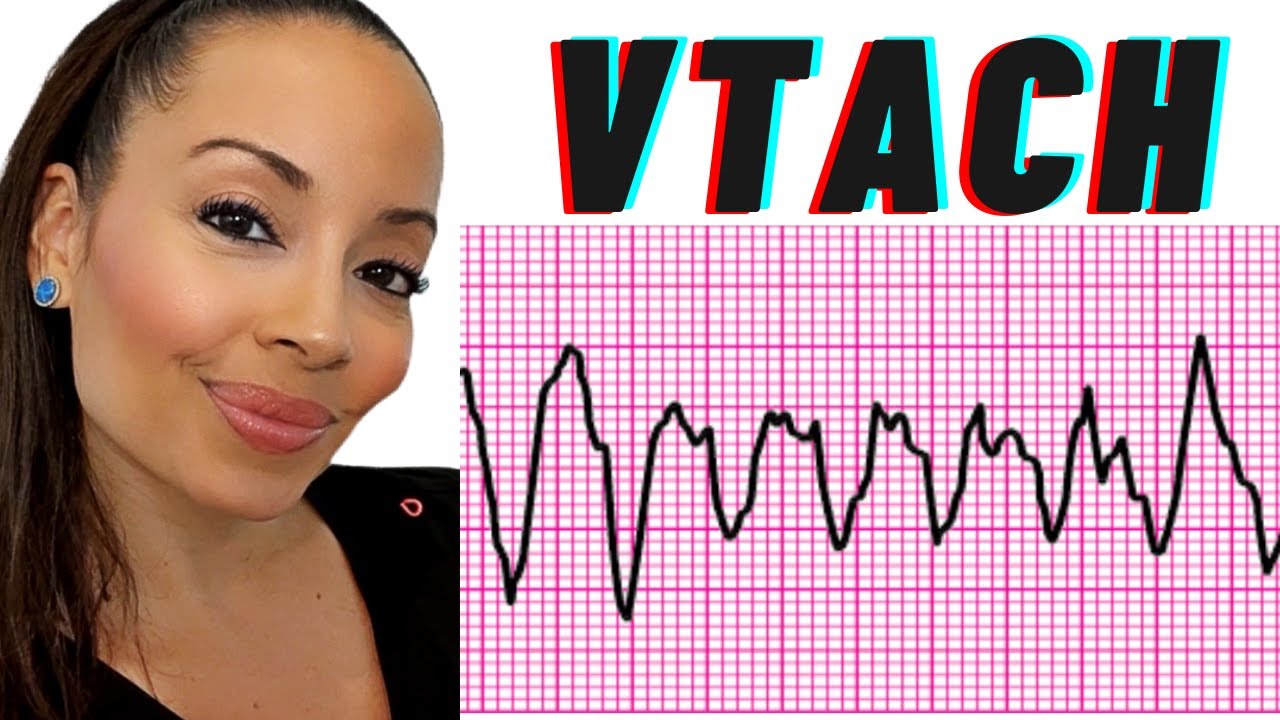 Ventricular Tachycardia (VTACH) ECG Interpretation, Causes, Treatment ...