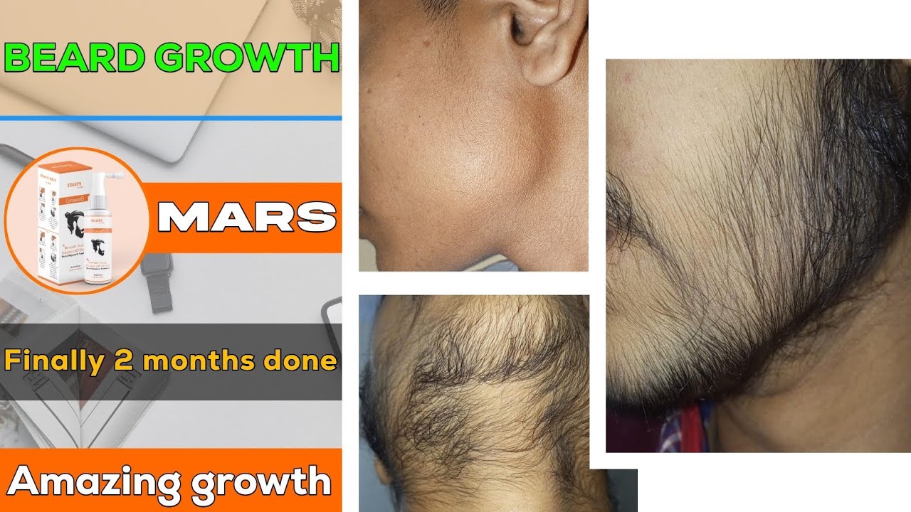 BEARD GROWTH | Amazing beard growth results | Finally 2 months done ️ ...