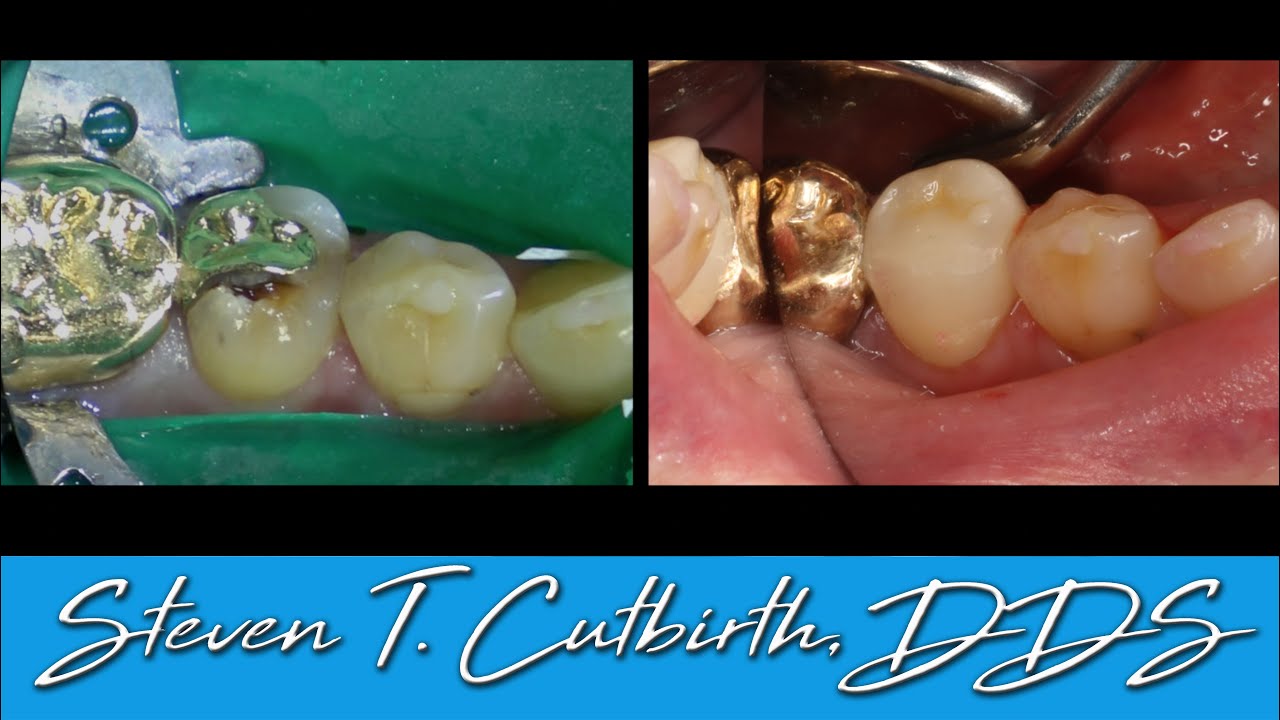 Mandibular Bicuspid Crown Preparation - Dental Minute with Steven T ...