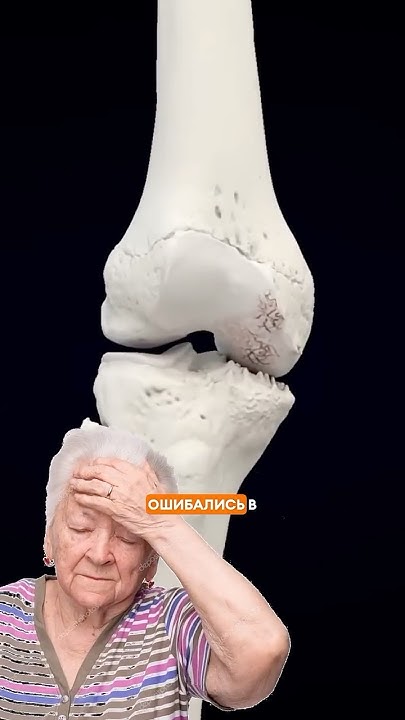 отложение солей в суставах - это миф! - YouTube