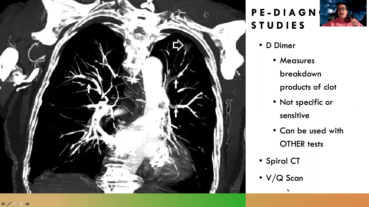 Complex: Pulmonary Embolism - YouTube