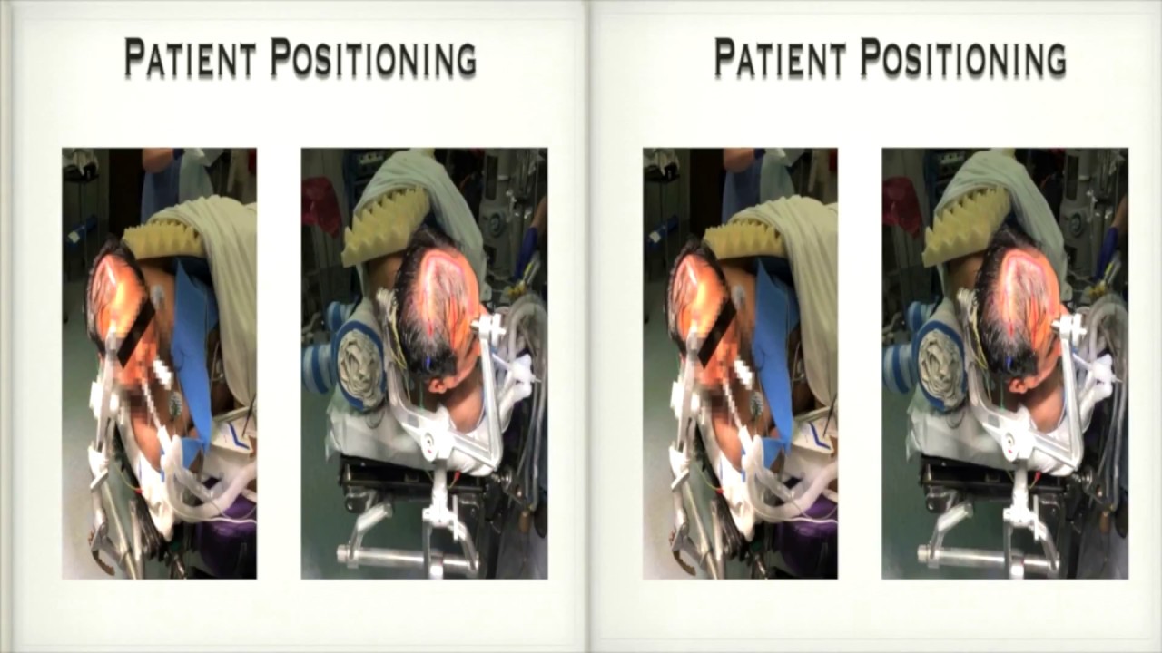 Contralateral transcallosal resection of a ventricular body AVM: 3D ...