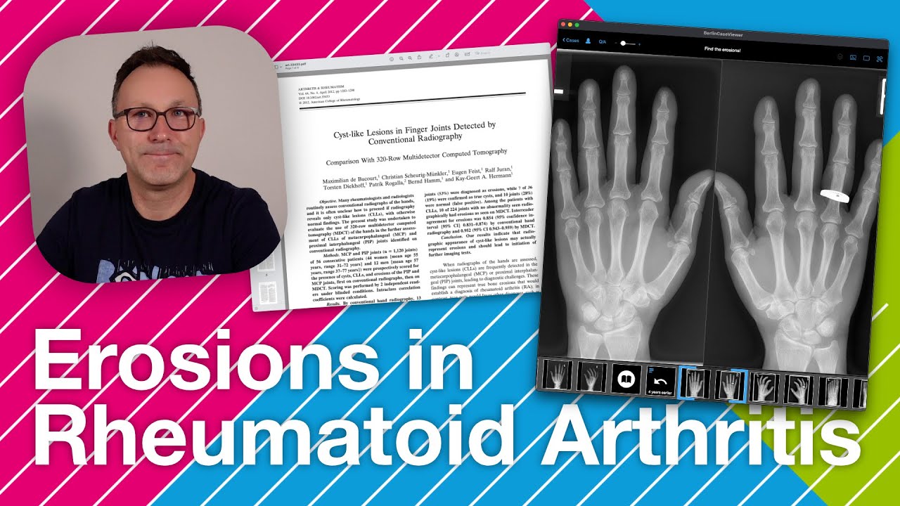 How to detect erosions on X-rays of the hands and feet and how to deal ...