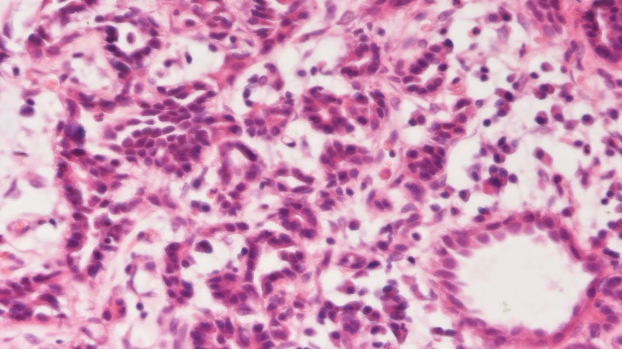 Nephrogenic Adenoma Pathology Mini Tutorial Youtube