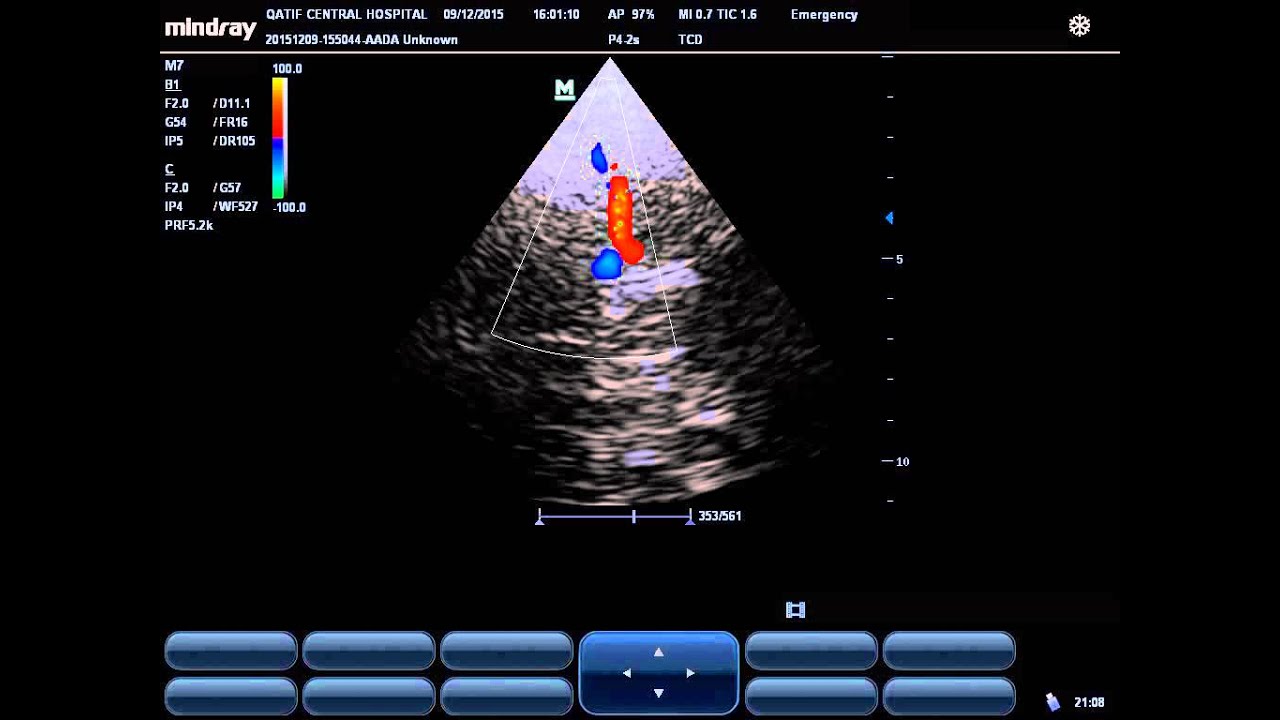 transcranial doppler in patient with hyperdynamic circulation due to ...
