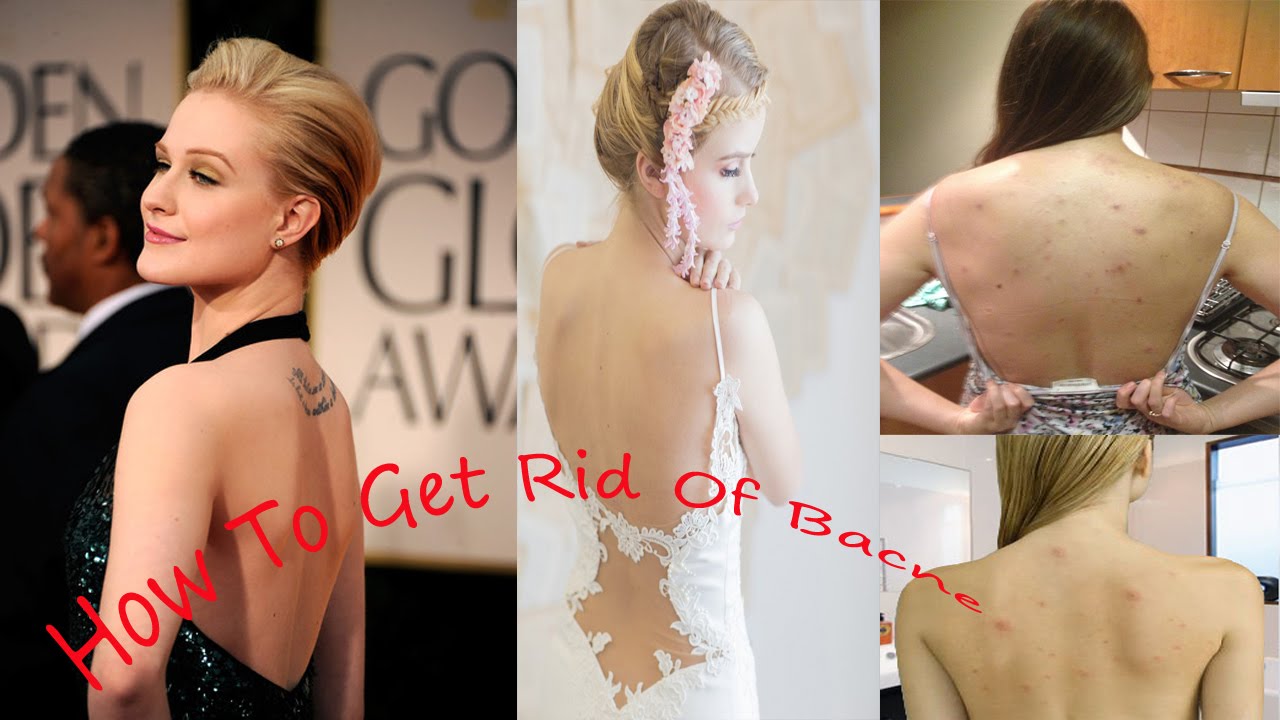 How To Get Rid Of Backne Get Rid Of Bacne At Home How Tos World