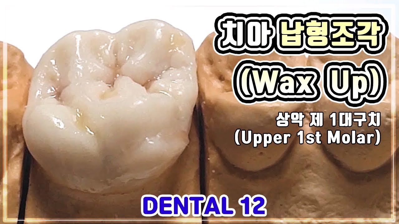 치과 관교의치 상악 제 1대구치 왁스업, wax up (Upper 1st molar wax pattern) [덴티에듀 ...