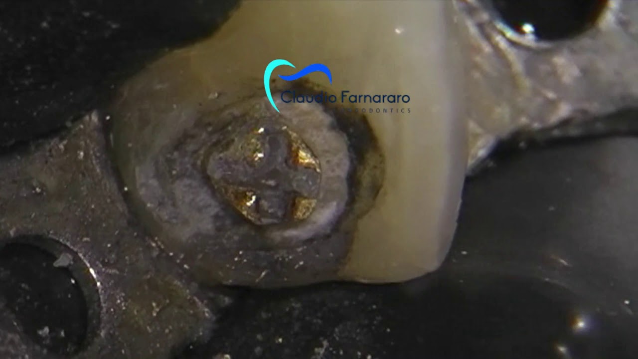 Removal of a dentatus screw in a premolar retreatment. - YouTube