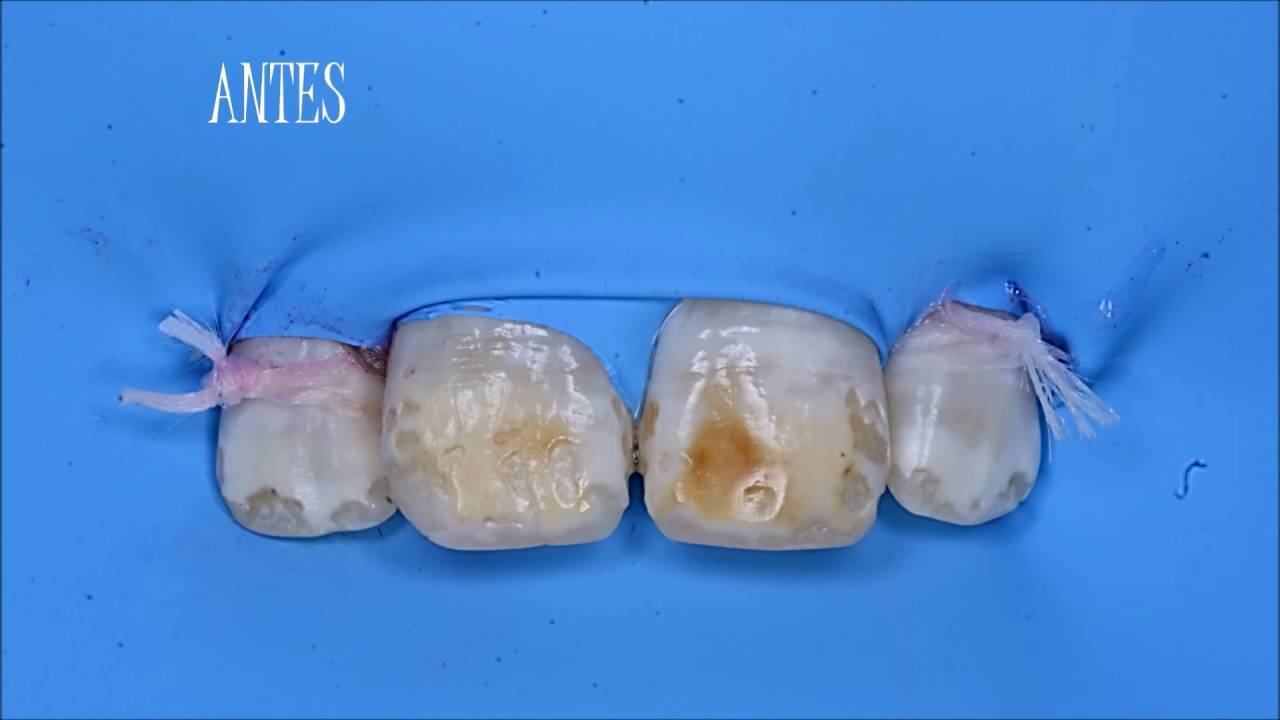 Antivet, técnica sin microabrasión - YouTube