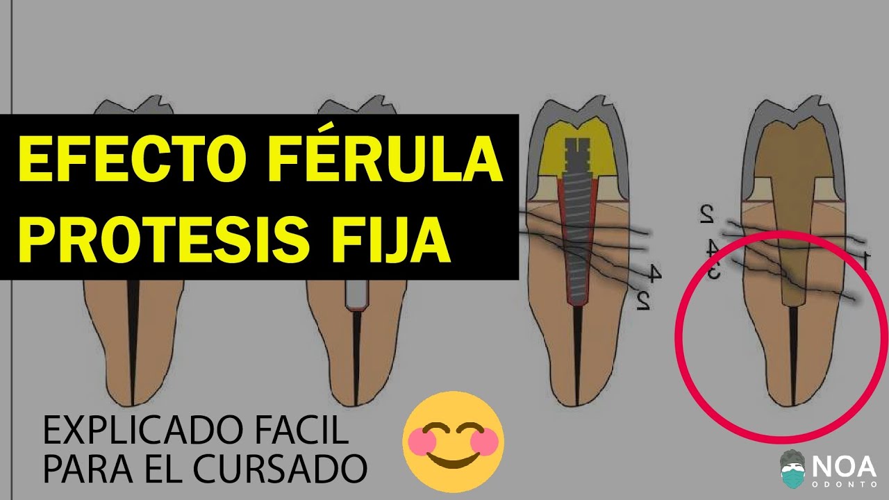 ¿QUE ES EL EFECTO FÉRULA😍 en Prótesis Fija para estudiantes de ...