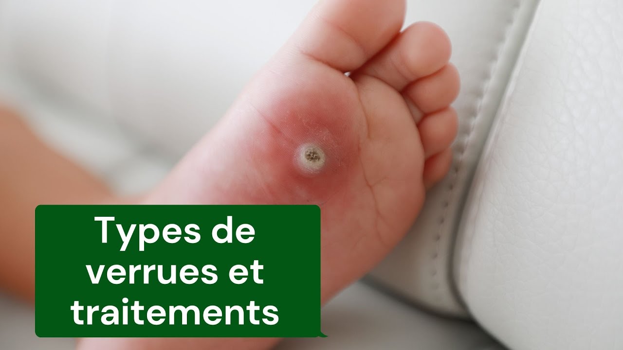Types de verrues et traitements - YouTube