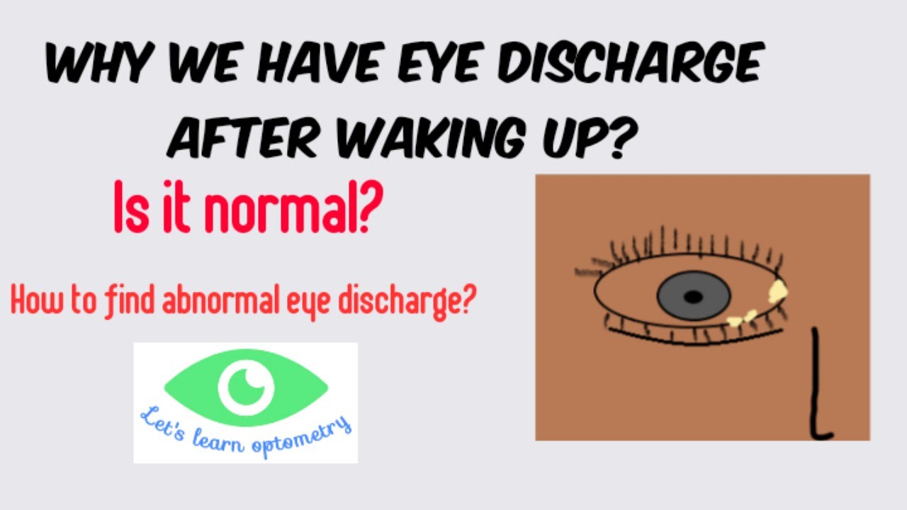 Eye discharge - YouTube