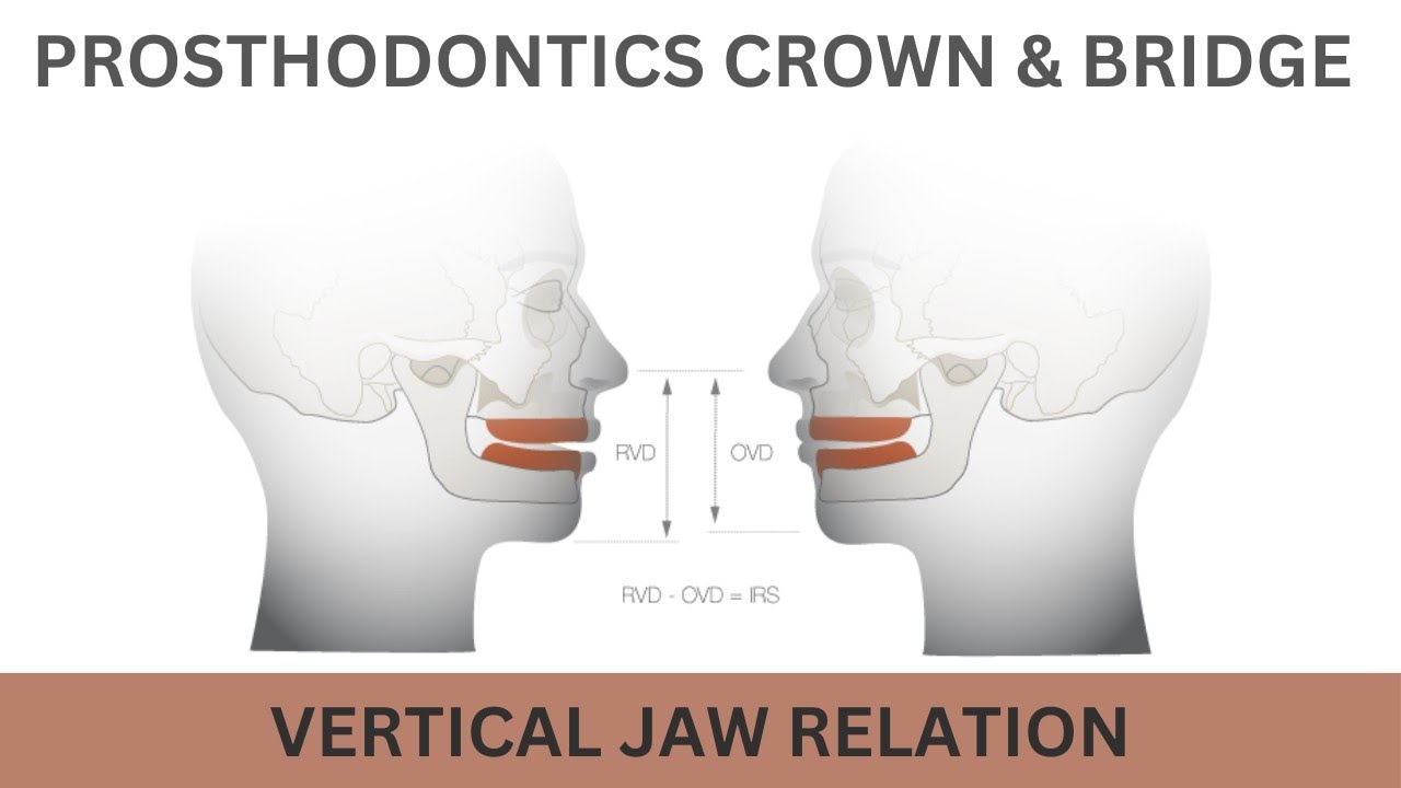 Methods of Vertical Jaw Relation in Complete Denture - YouTube