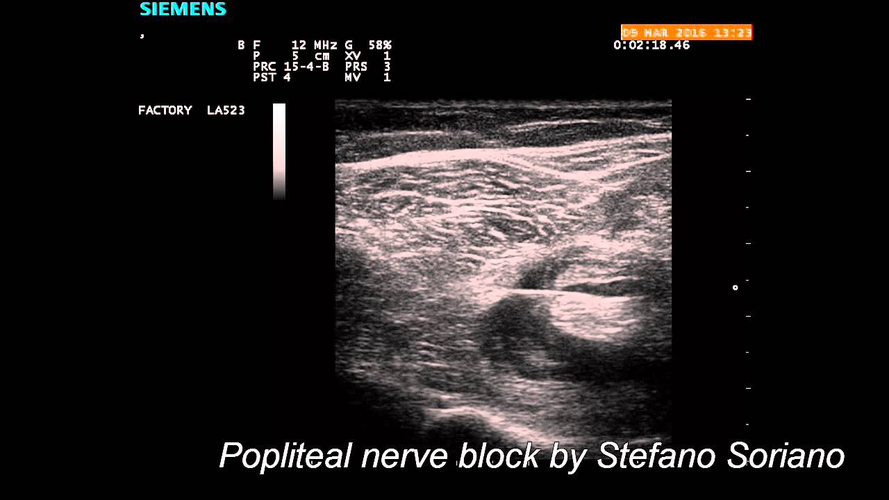 New Approach Of Ultrasoundguided Genitofemoral Nerve [PDF] Ultrasound ...