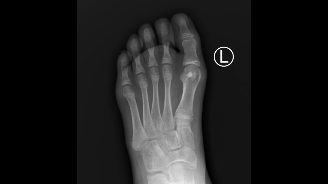 3rd Toe Fracture (Xray 19) - YouTube