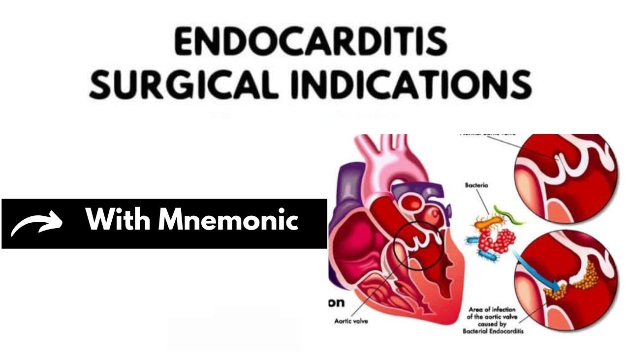Endocarditis Indications For Surgery at Douglas Hairston blog