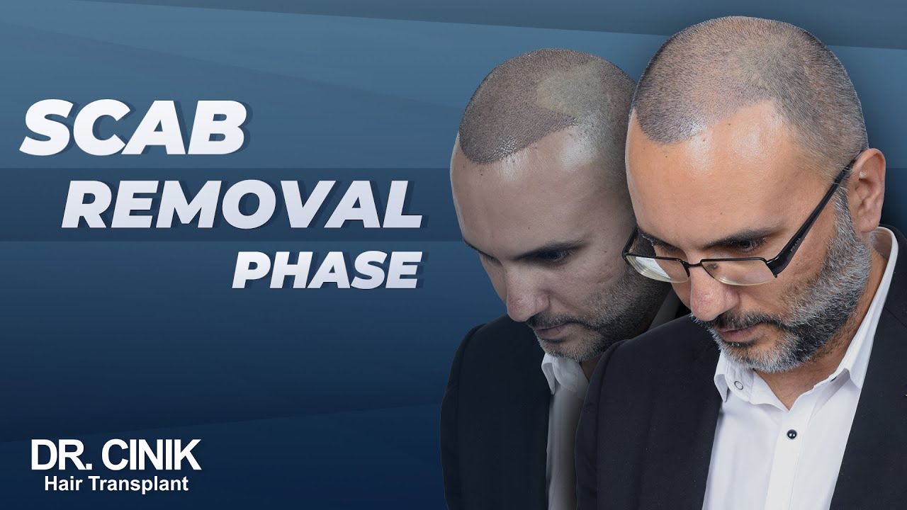 Scab Removal Phase | Dr.Cinik Hair Transplant - YouTube