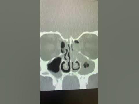 CT scan Sinus / PNS . How to read. Unilateral sinus disease. Para nasal sinus - YouTube