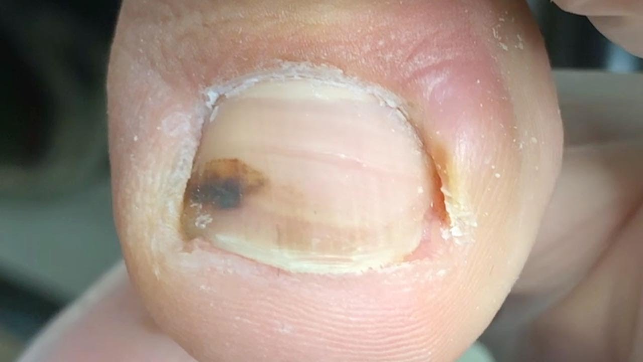 Professional pedicure: dig out hidden ingrown nails【DrZhang】 - YouTube