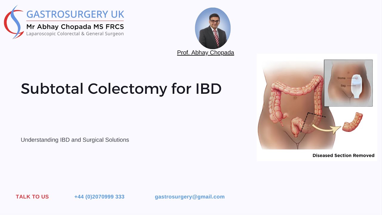 Subtotal Colectomy for IBD: Modern Surgical Approach | Dr. Abhay ...