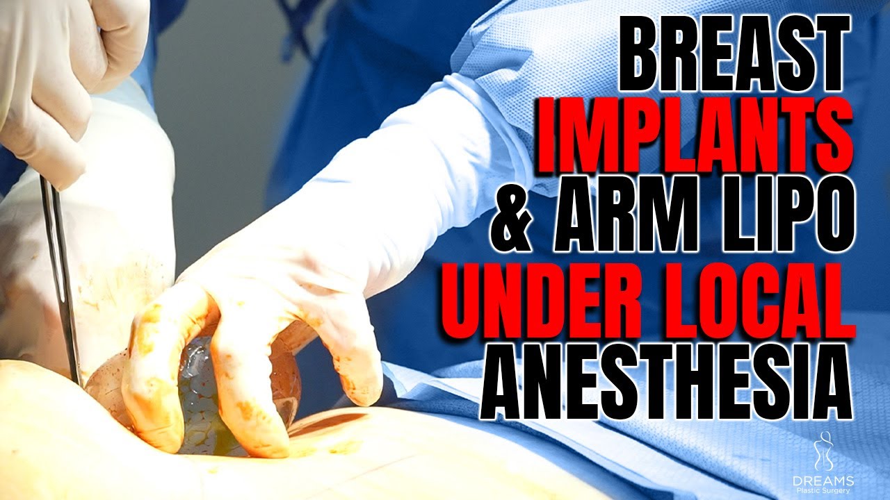 Breast Implants, upper back & arm lipo: Can You Get Them Without ...