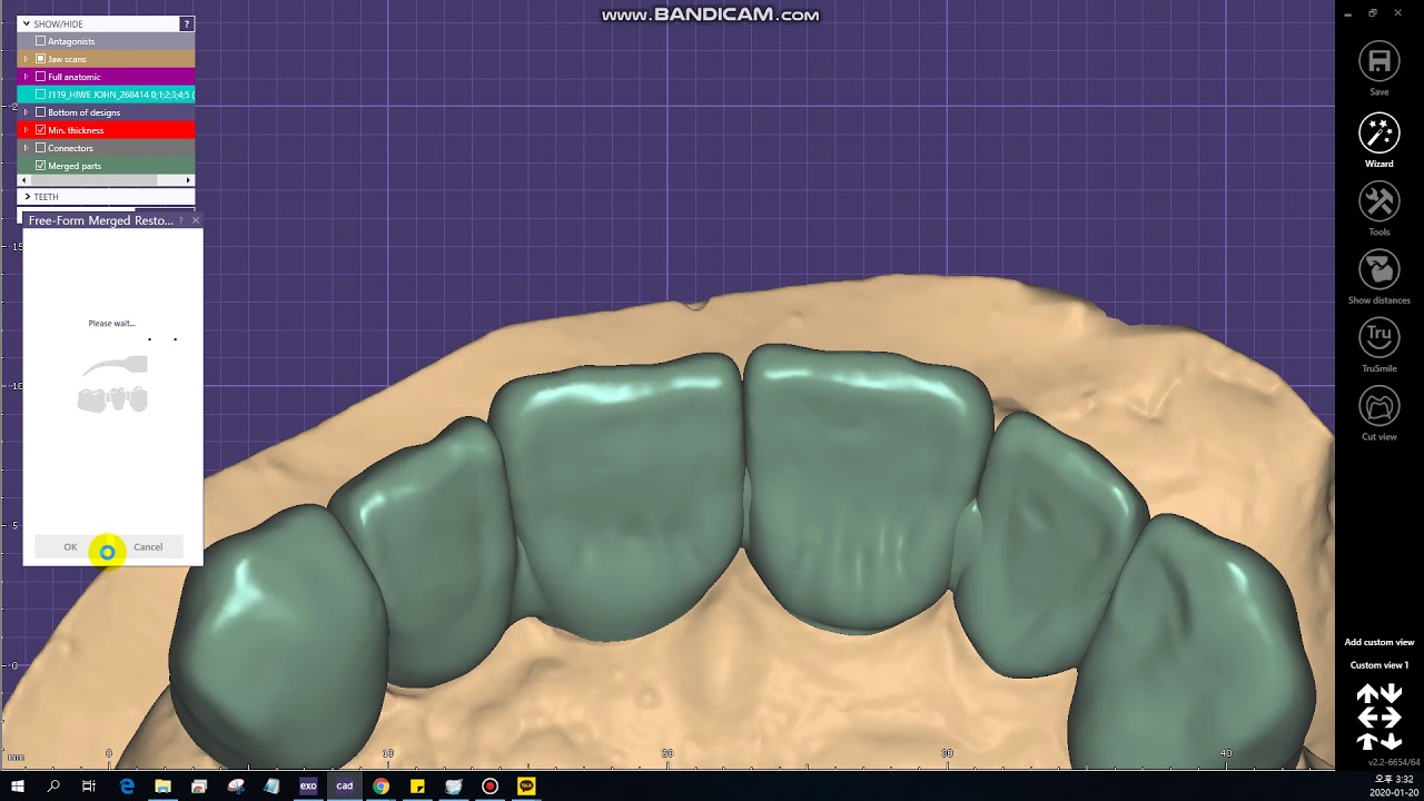 Exocad, design adjust, Singles to bridge - YouTube