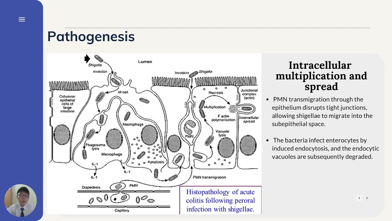 Shigellosis Pathogenesis and its Virulence Factors - YouTube