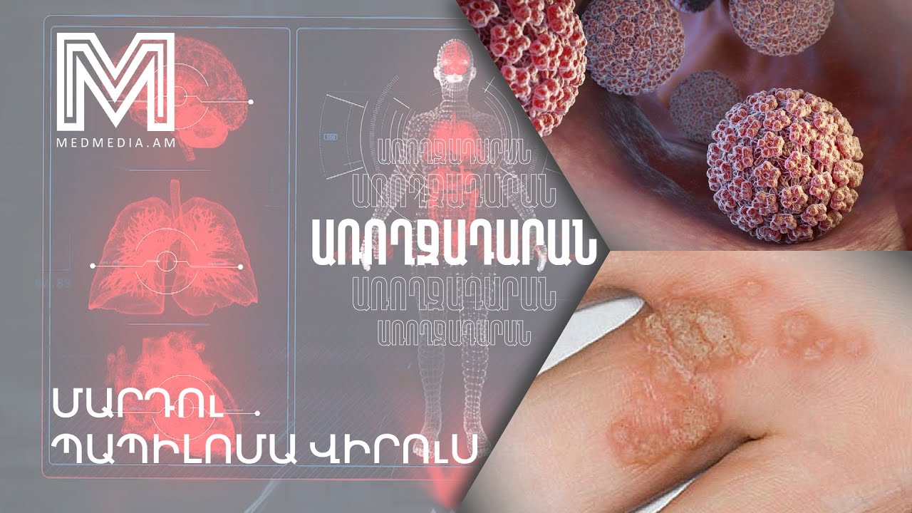 Ի՞նչ է մարդու պապիլոմա վիրուսային վարակը։ Ի՞նչ անել վարակը ...