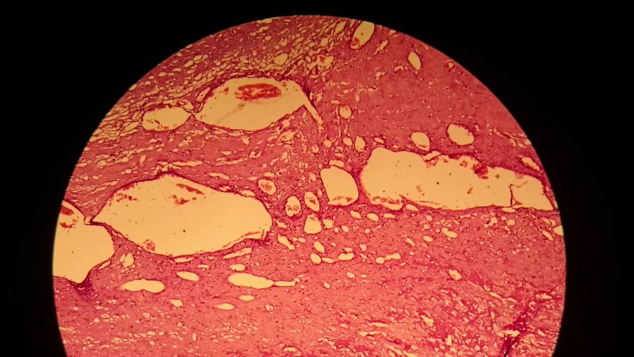 1- Myocardail infarction - Coagulative necrosis - Heart - YouTube