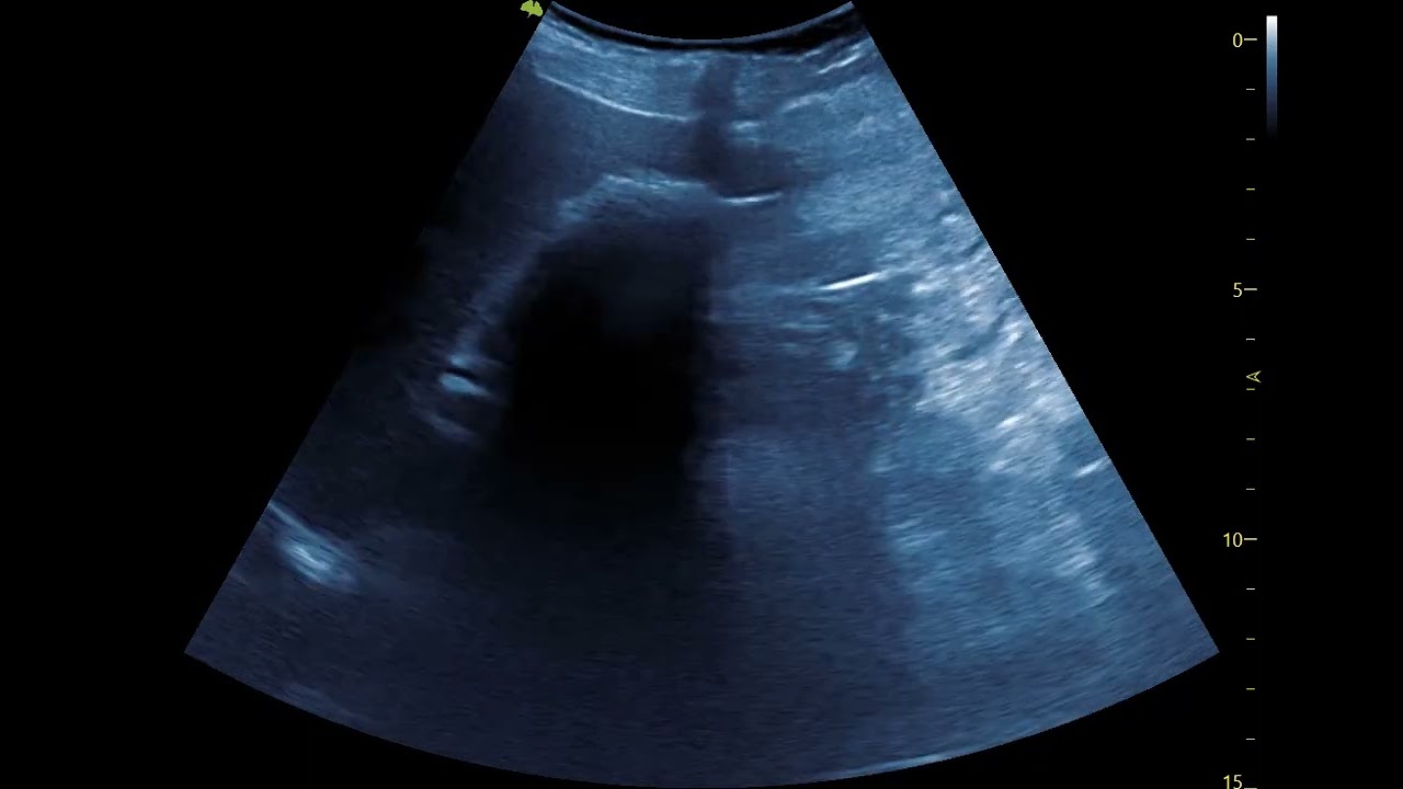 gallbladder stone. WES sign - YouTube