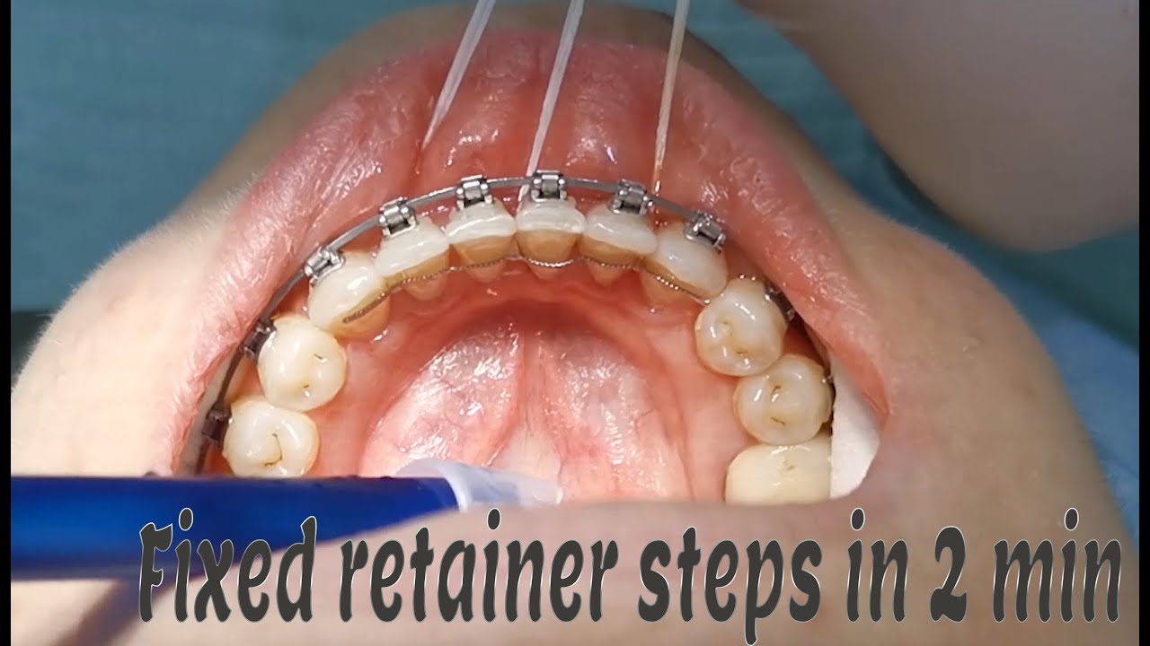 Fixed #orthodontic retainer steps - YouTube