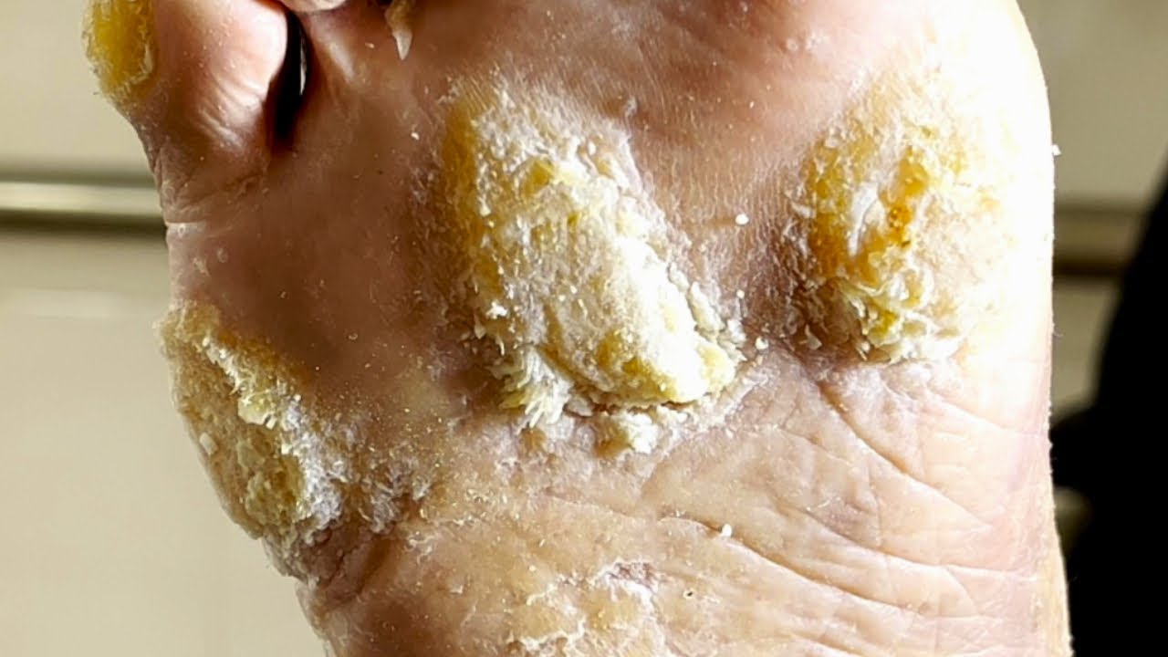 3 Eyes Grow Out Of The Sole Of The Foot~【Podiatry Clinic】 - YouTube