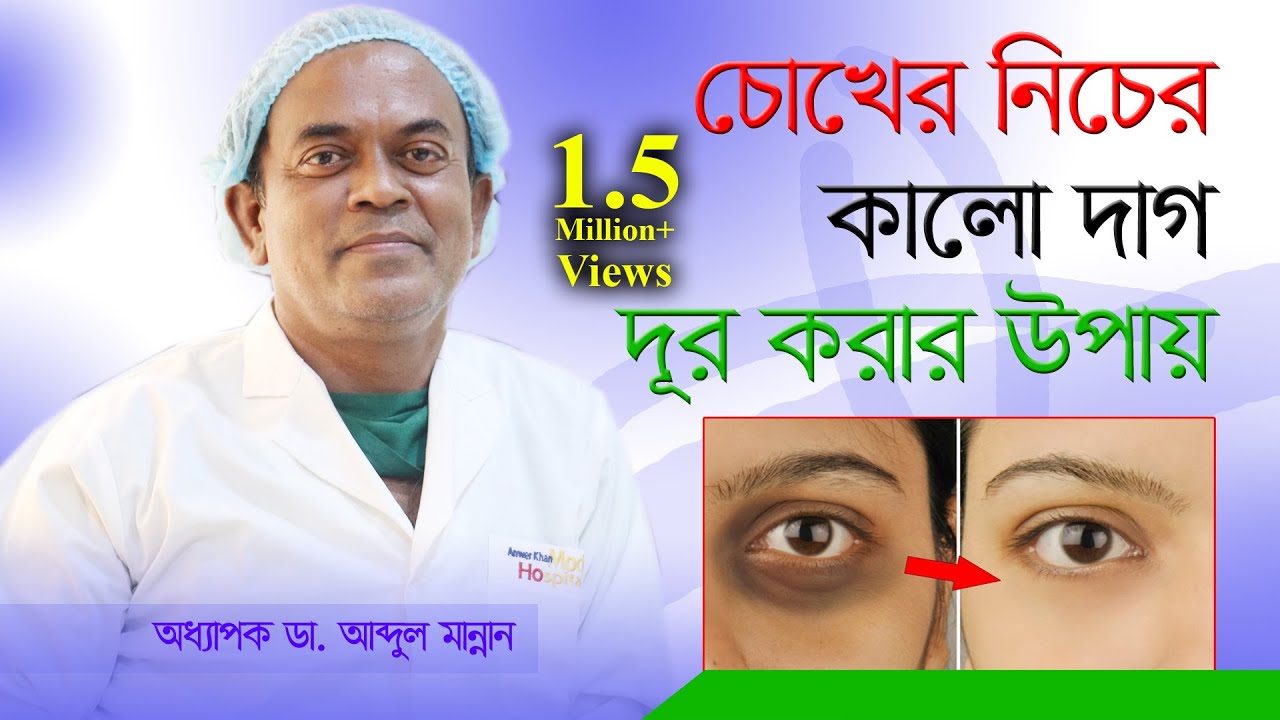 How To Remove Dark Circles | চোখের নিচের কালো দাগ দূর করার উপায় ...