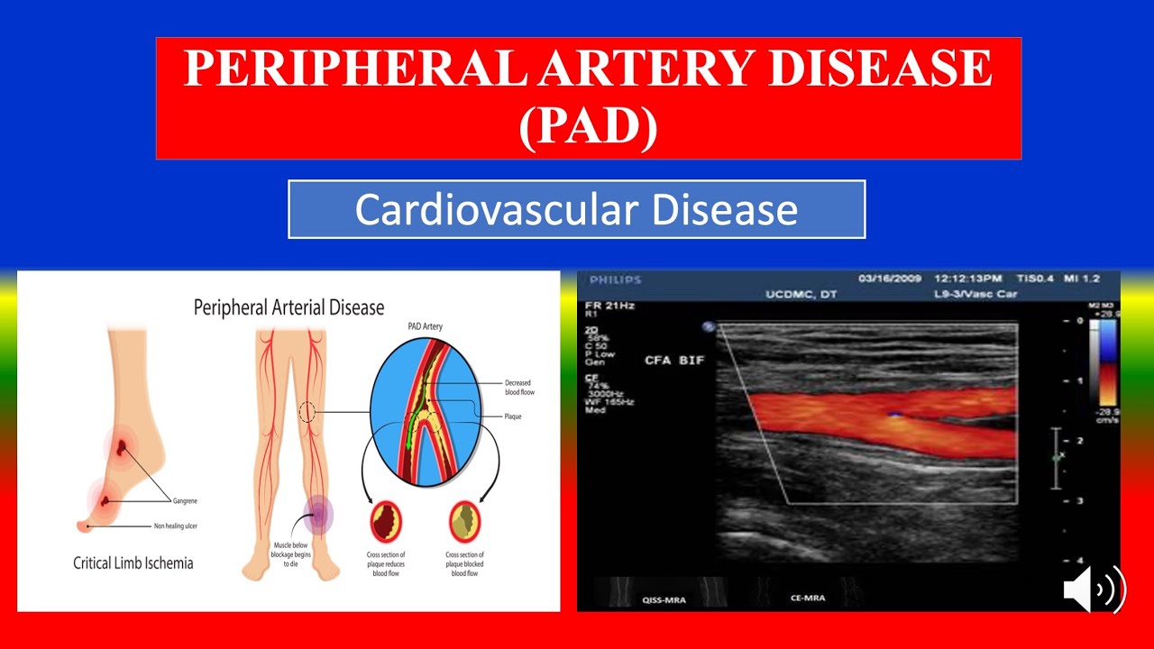 PERIPHERAL ARTERY DISEASE (PAD) - Definition, types, cusses ...