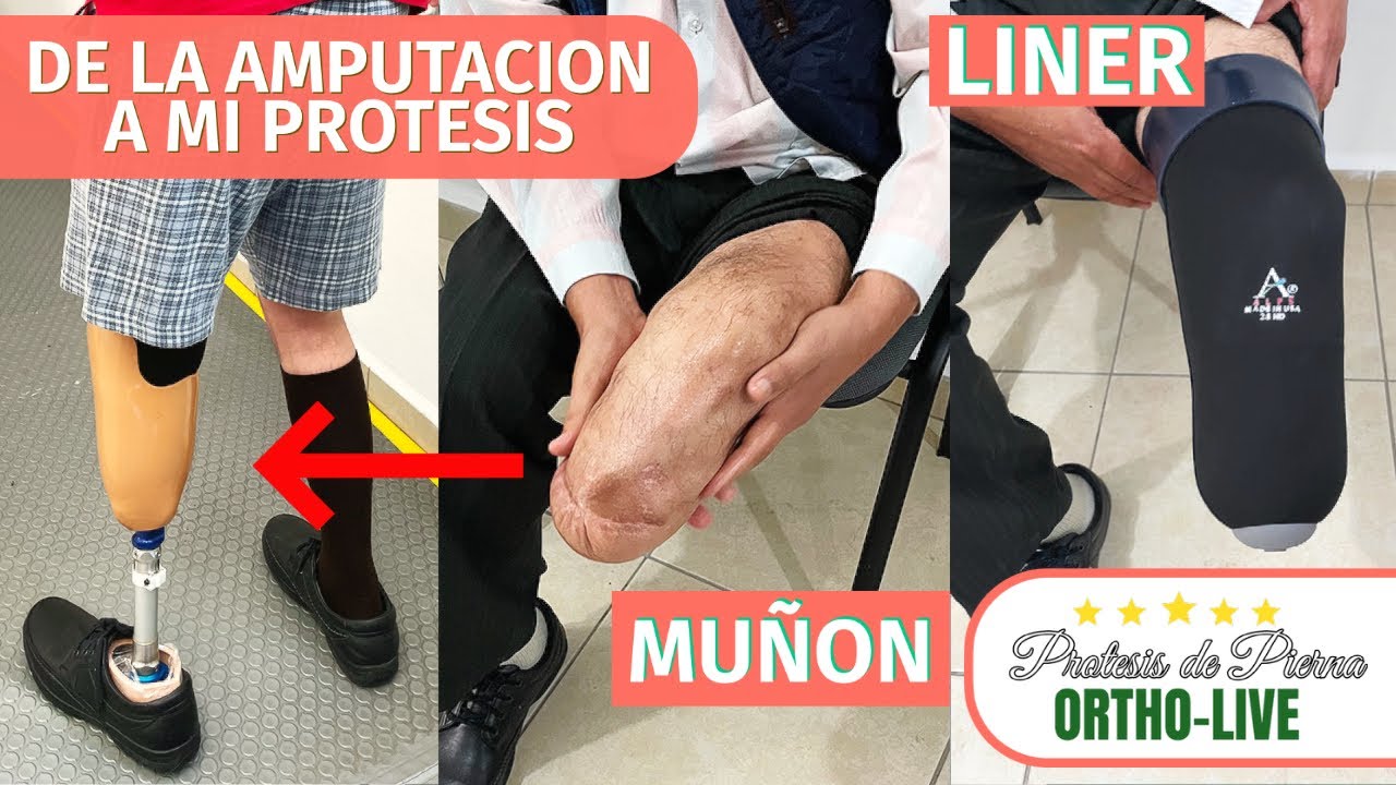 DE LA AMPUTACION A MI PROTESIS TRANSTIBIAL ORTHO-LIVE MEXICO - YouTube