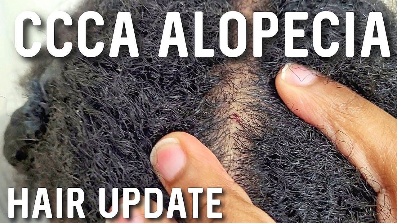 CCCA Alopecia Hair Update | Hair Loss & Scalp Care #alopeciahairloss ...
